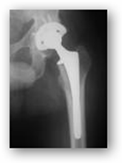 Hip Replacement Study Released - Metal on Metal Devices Are Beginning ...
